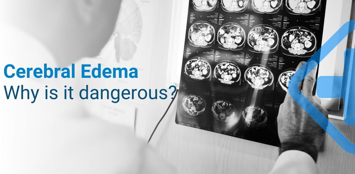 Cerebral Edema: Why is it dangerous? Causes, Symptoms, and Treatment