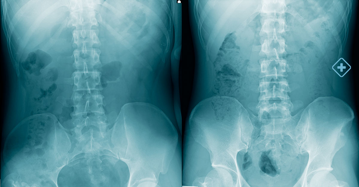 Back Surgery: Before, During and After Surgery