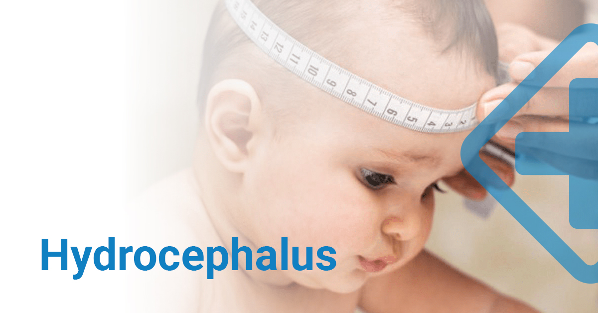 Hydrocephalus. Causes, Symptoms, Diagnosis and Treatment.