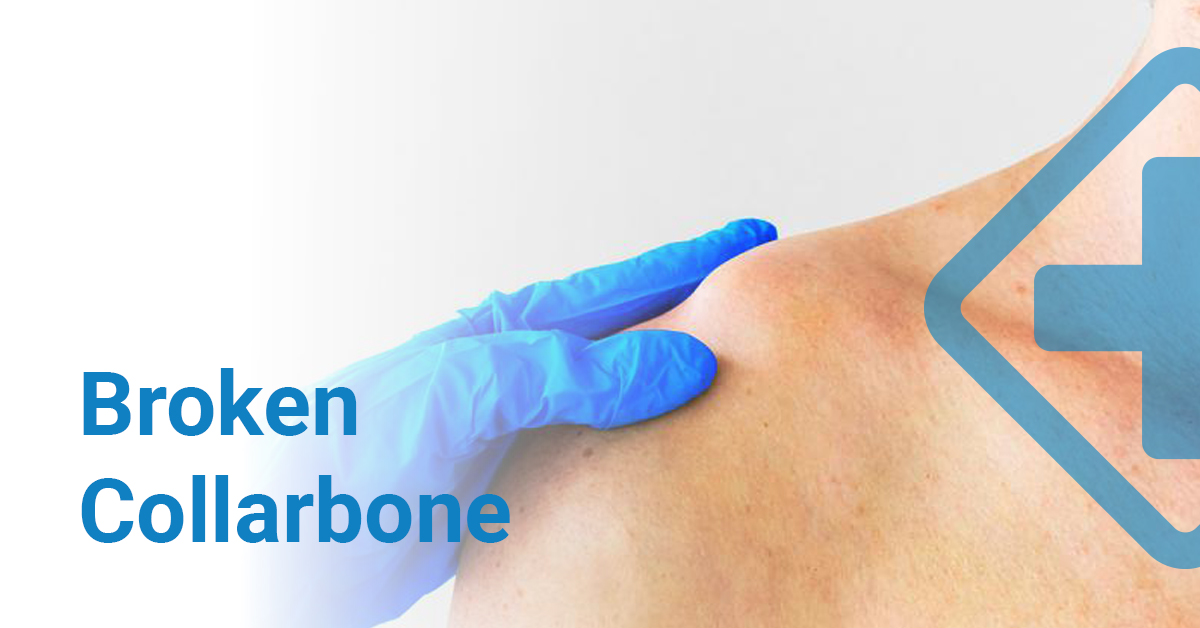Broken Collarbone: Causes & Treatments Of A Clavicle Fracture