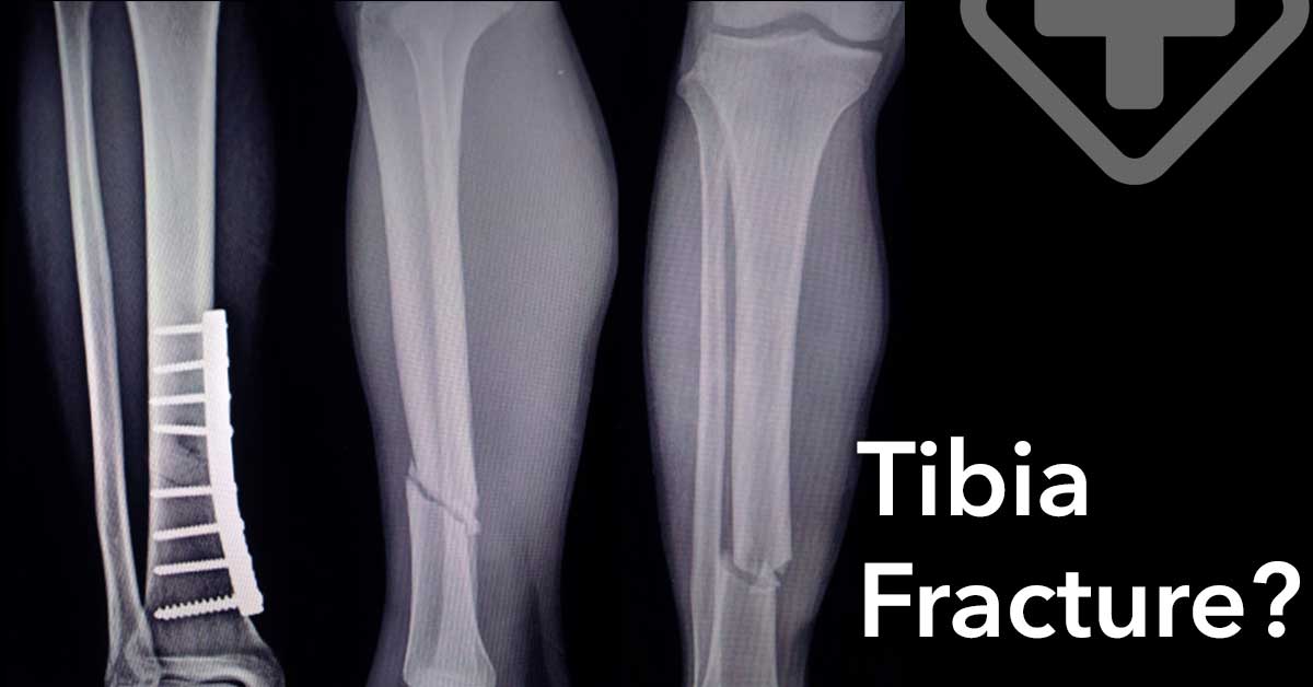Tibia Fracture: Causes, Symptoms, Diagnosis and Treatment.