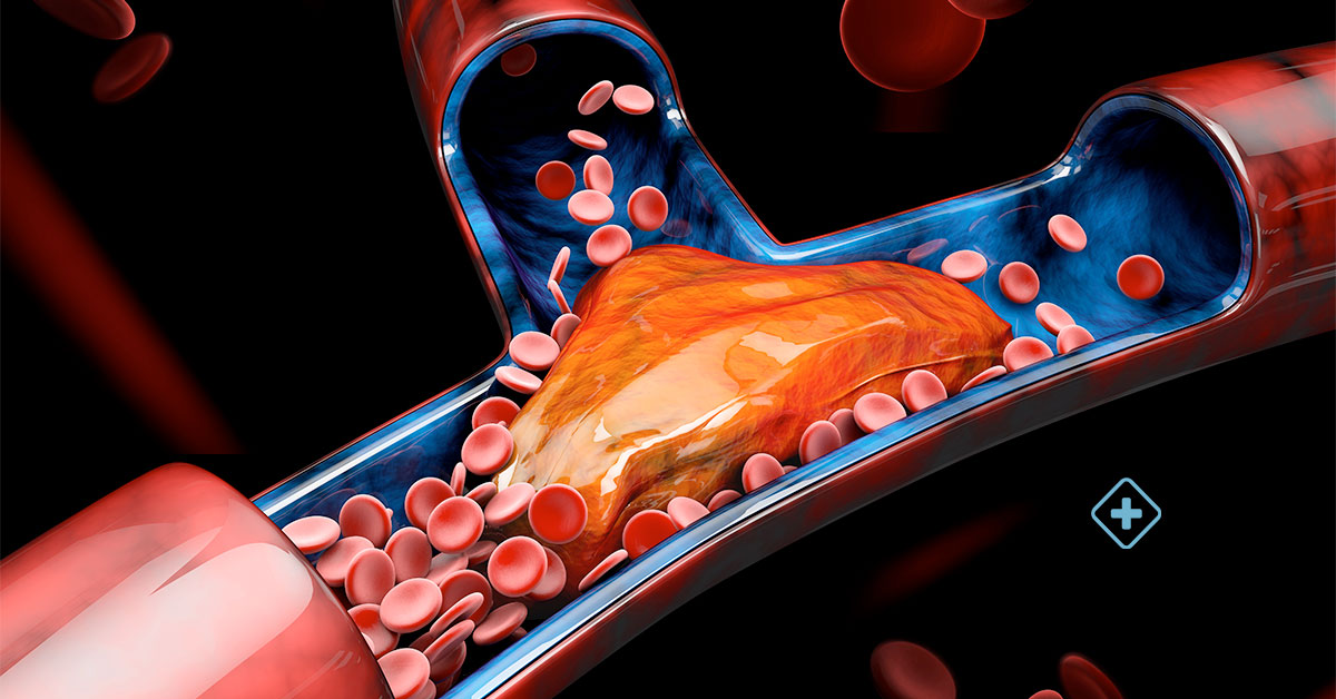 Tromboembolism: Symptoms, Causes & Prevention