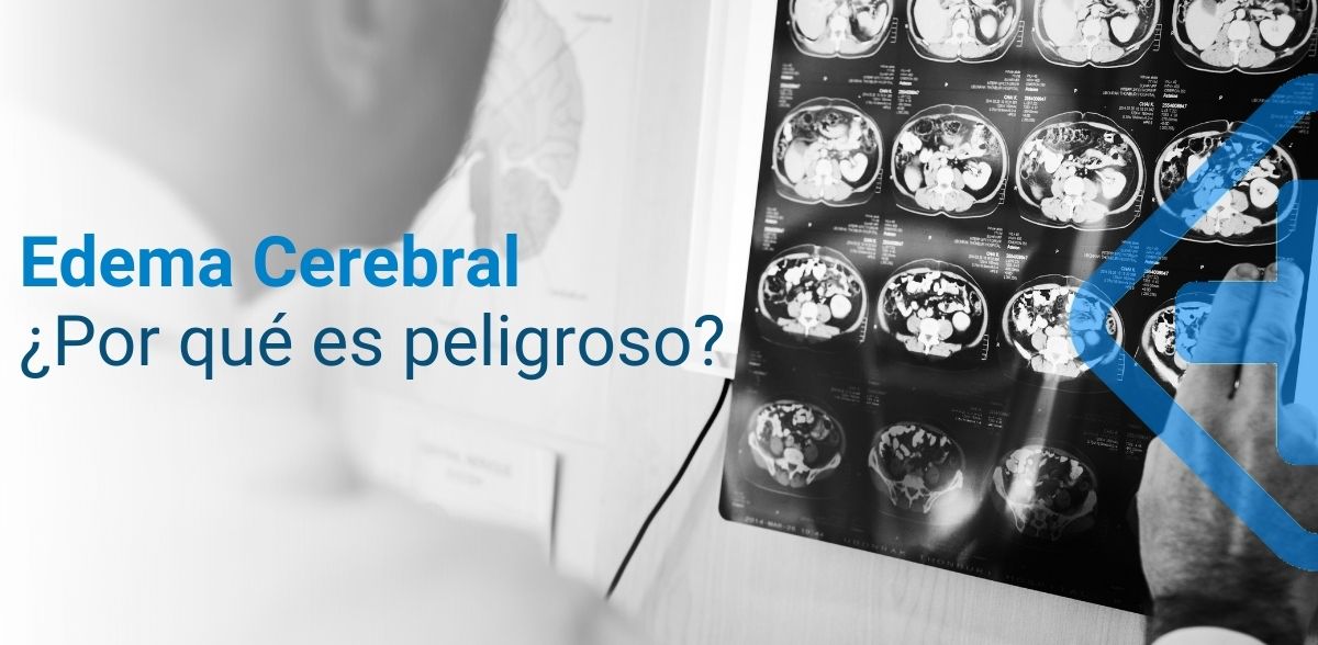 Edema Cerebral ¿Por qué es peligroso? : Causas, Síntomas, y Tratamiento