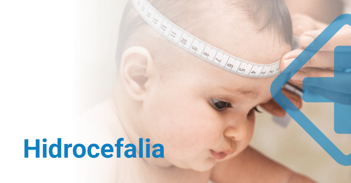 Hidrocefalia. Causas, Sintomas y Diagnóstico