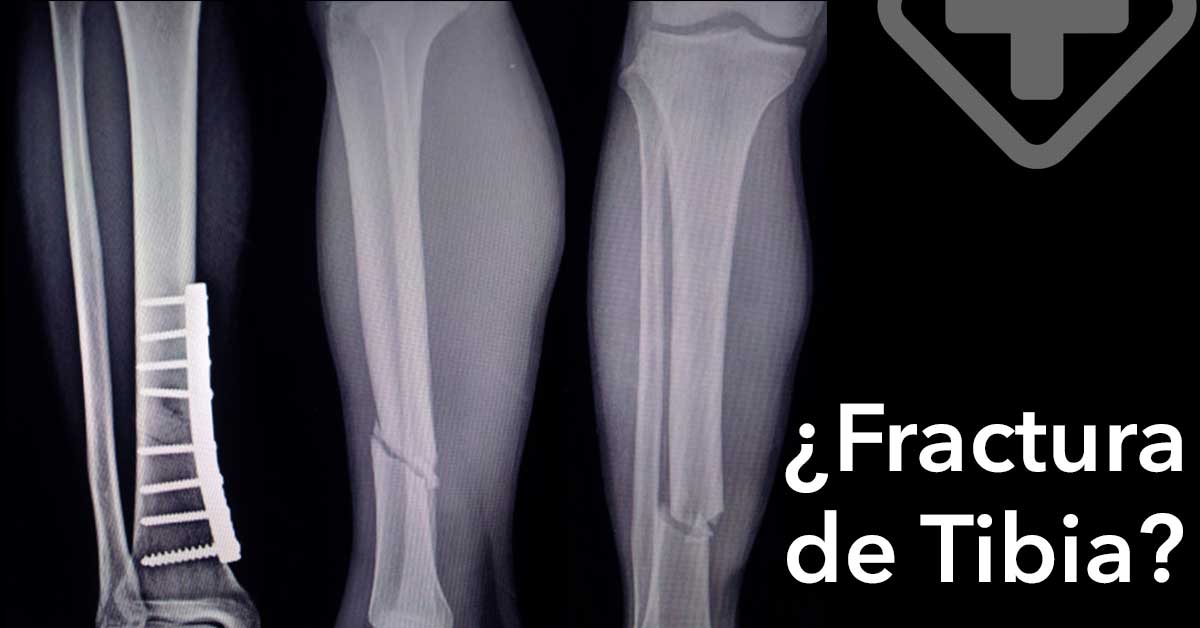 Fractura de tibia: Causas, Síntomas, Diagnóstico y Tratamiento.