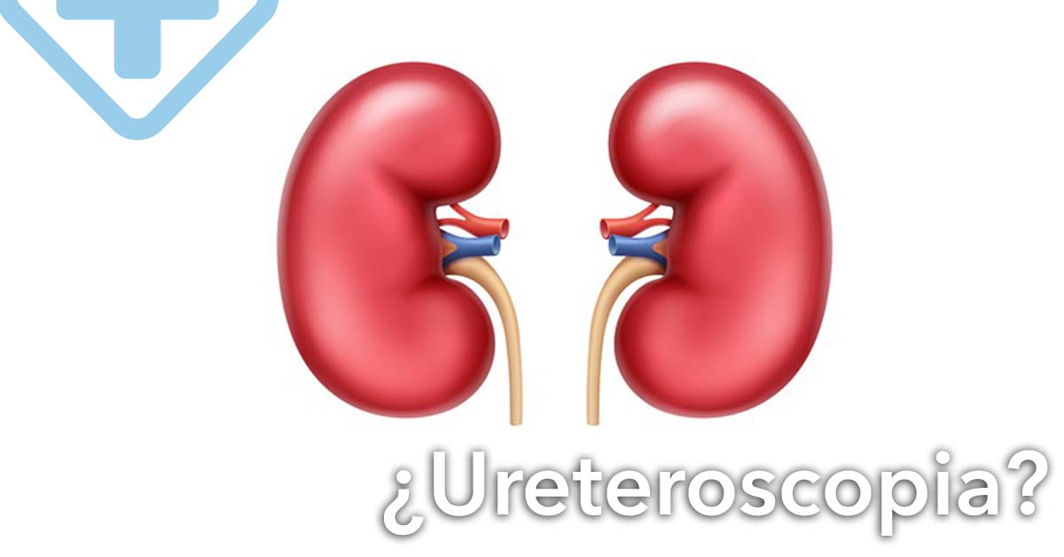 Ureteroscopia: Antes, Durante & Después